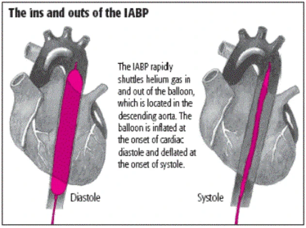Intra-aortic balloon pump (IABP) - BMET Wiki