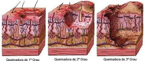Queimaduras - Infomedica Wiki