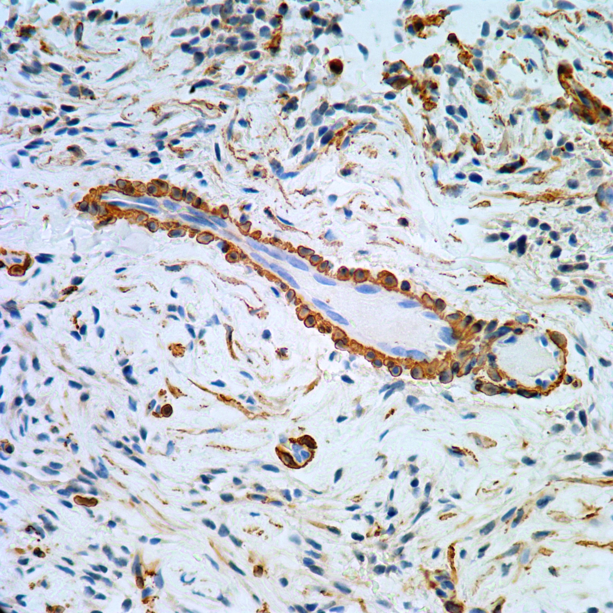 Image - SMA.pericytes.400x.jpg - Pathology Resident Wiki
